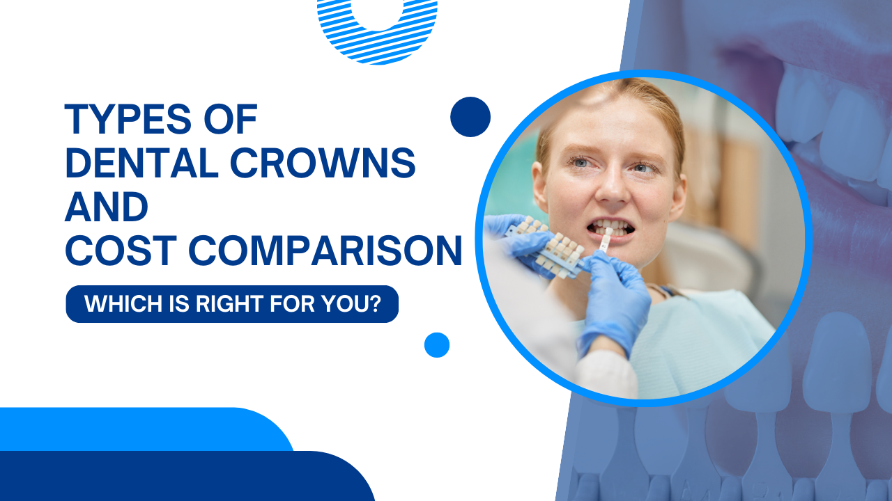Types of Dental Crowns and Cost Comparison: Which is Right for You ...